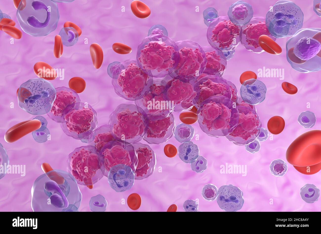 Acute lymphoblastic leukemia (ALL) cancer cell clusters in the blood ...