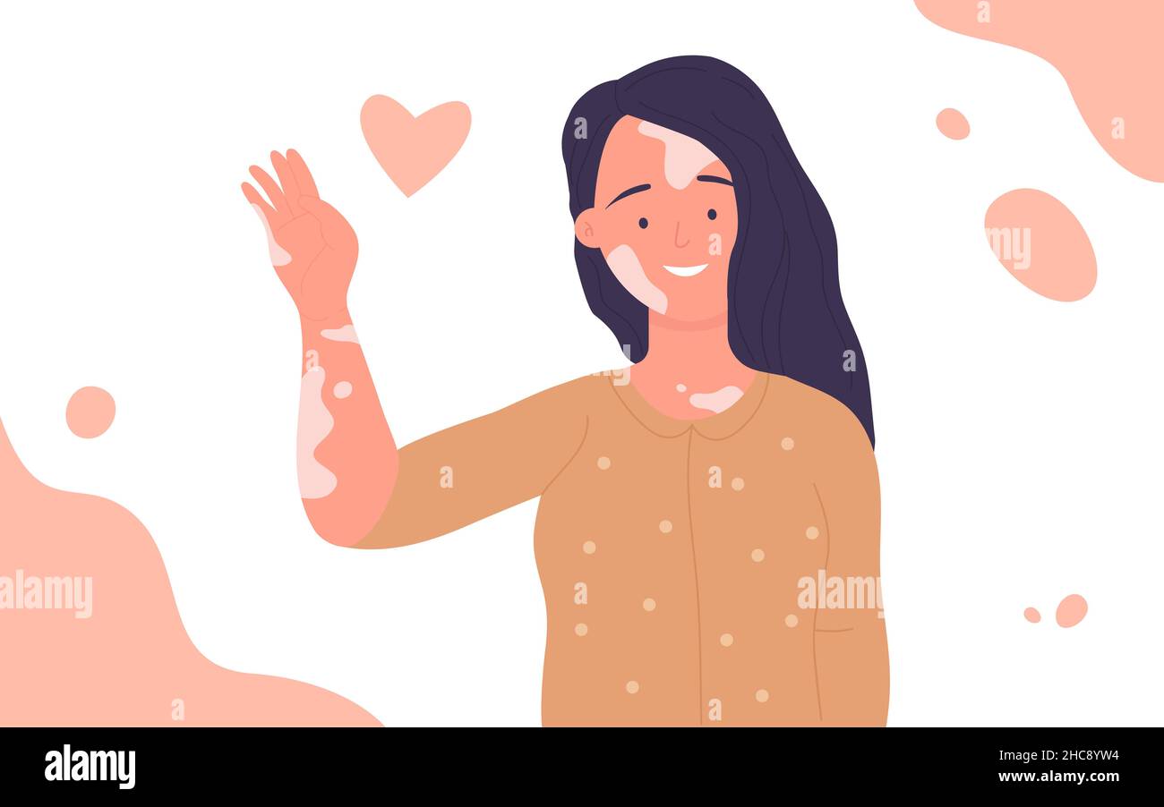 Girl with skin problems vitiligo vector illustration. Cartoon young ...
