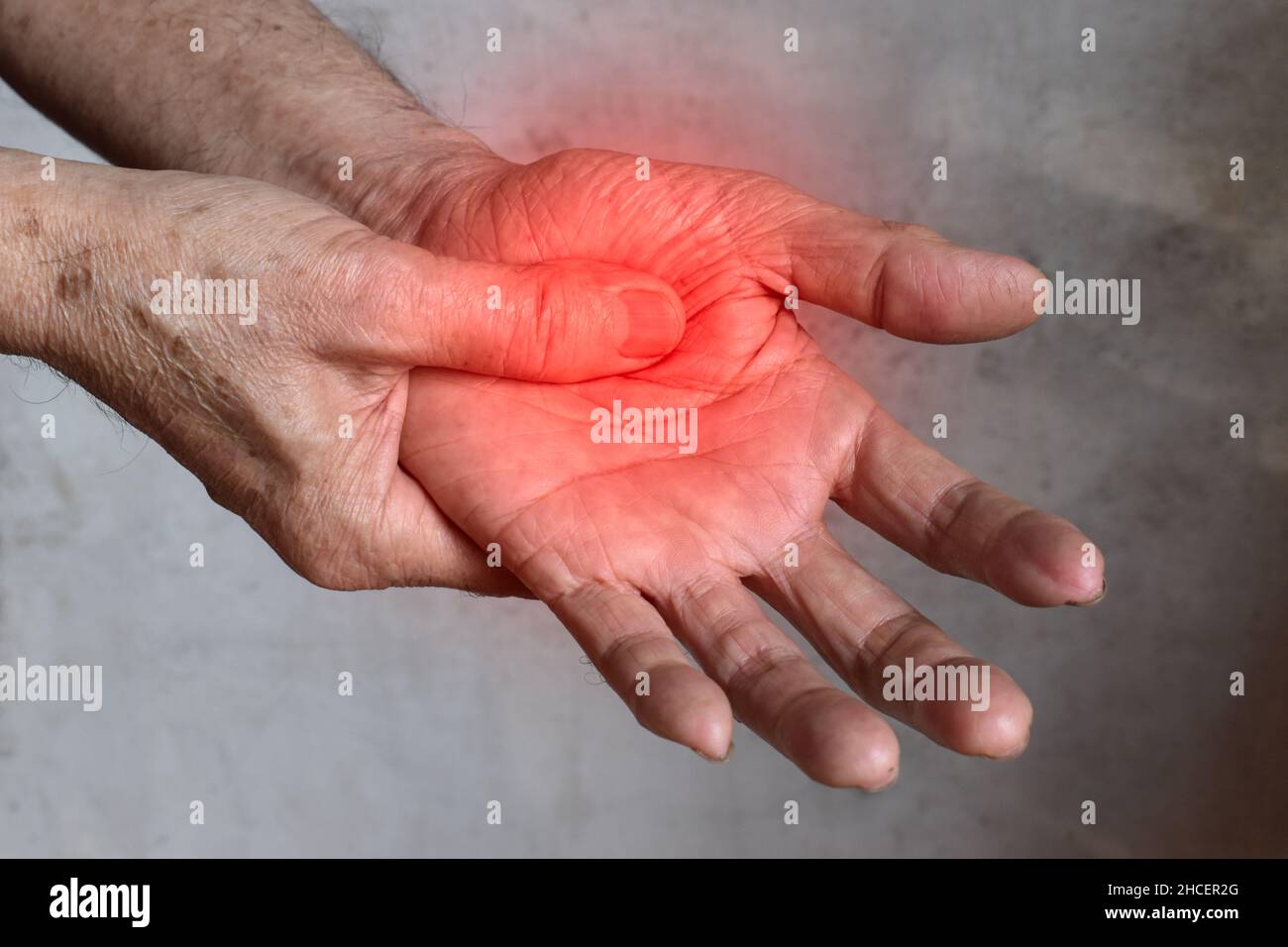 Painful palmar aspect of Asian old man. Concept of compartment syndrome ...