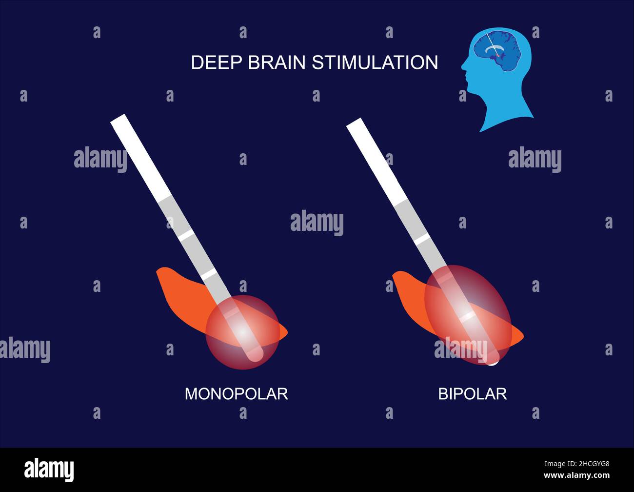 Parkinsons Deep Brain Stimulation Stock Vector Images Alamy
