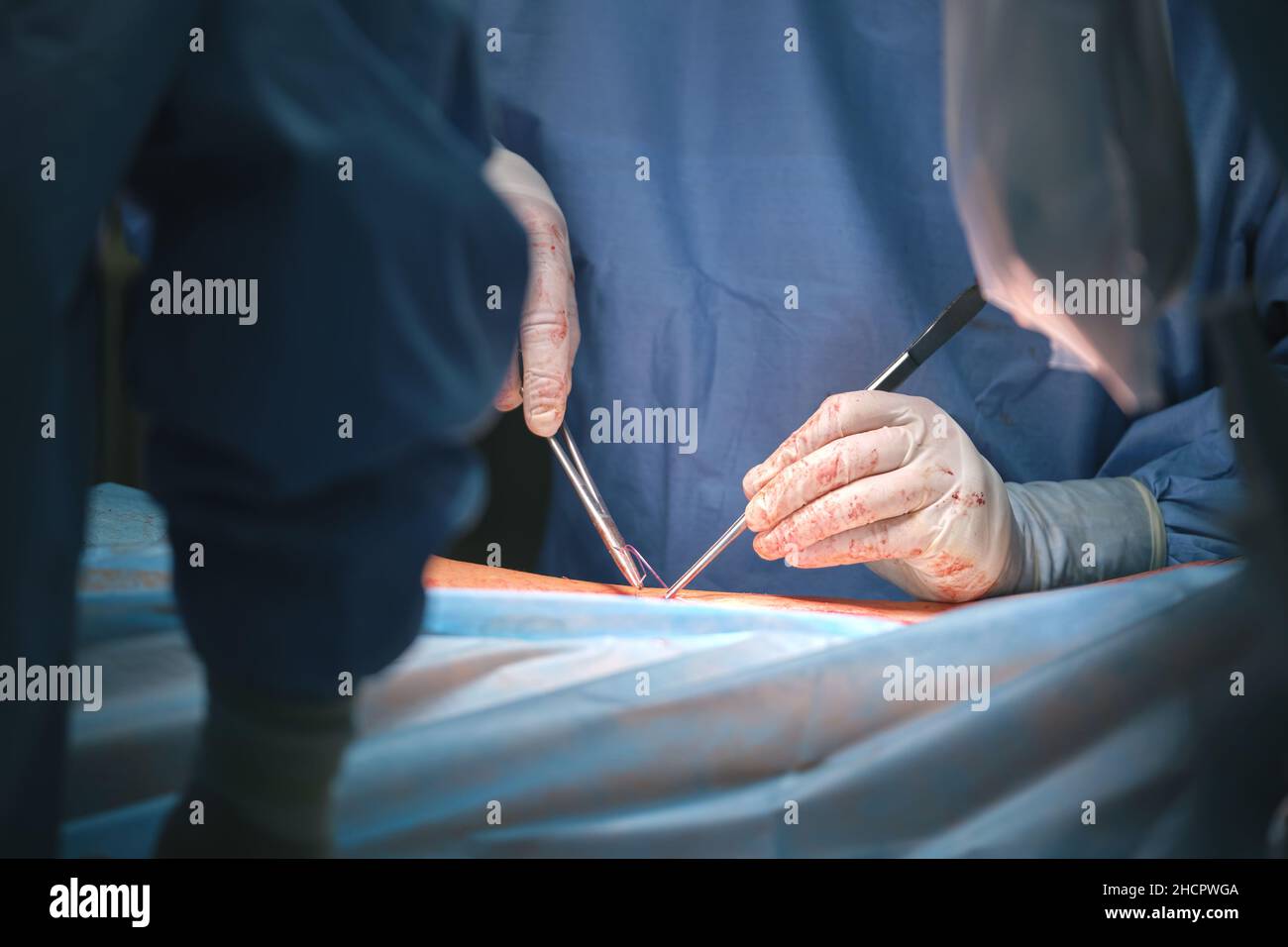 Team of professional doctors operating a patient conducting open cut ...