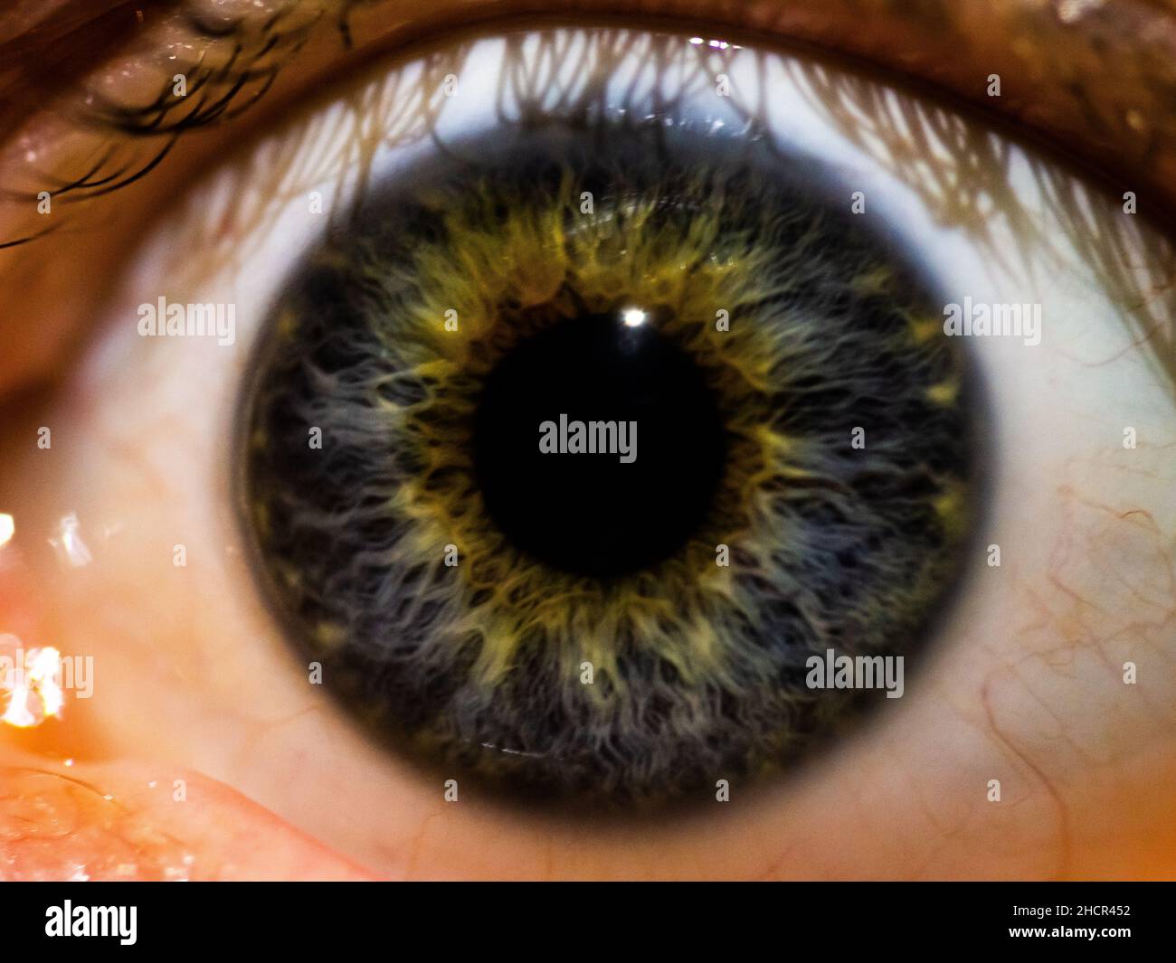 Central Heterochromia Iridis