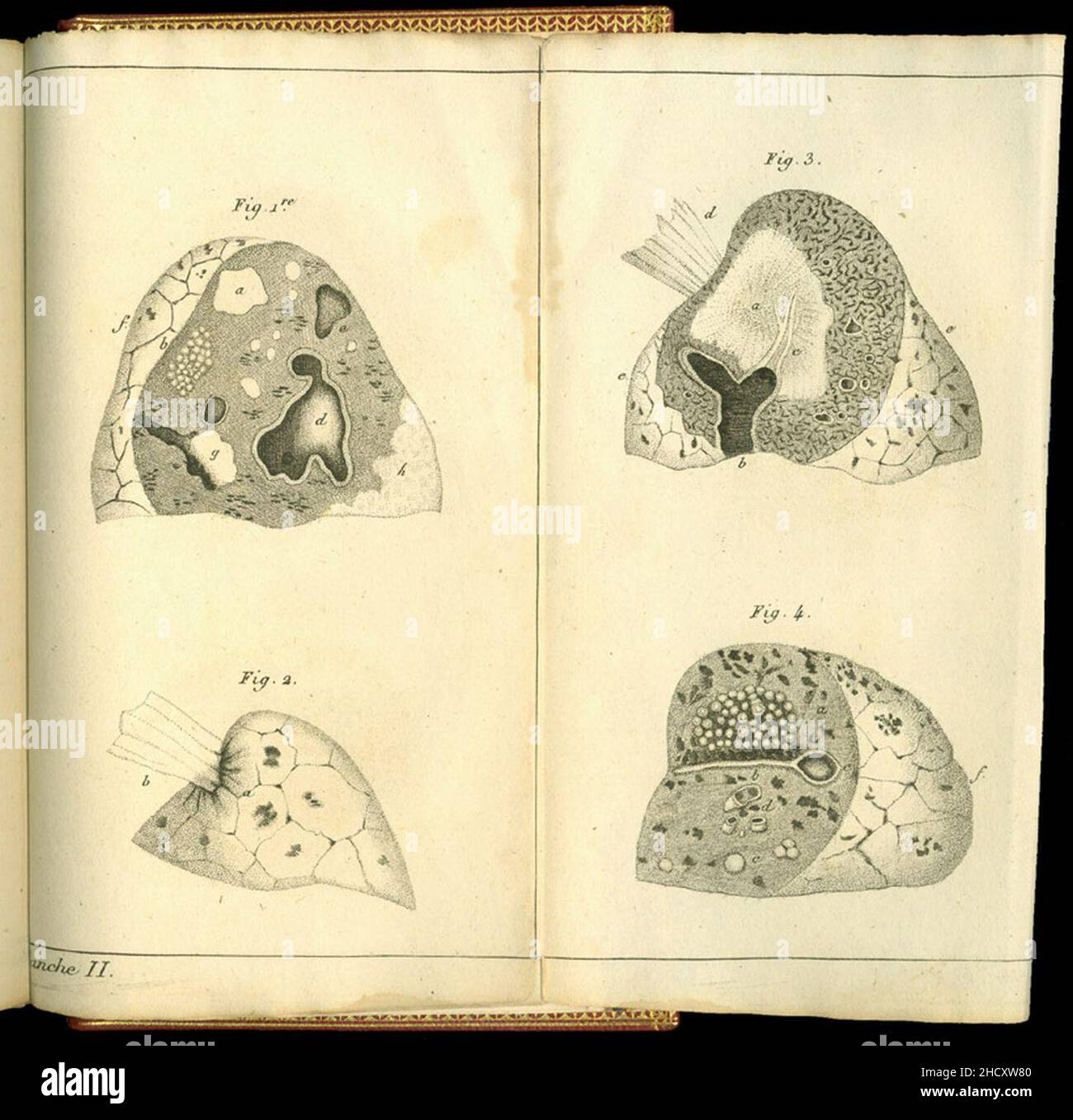 Rene-Theophile-Hyacinthe Laennec (1781-1826) Drawings diseased lungs ...