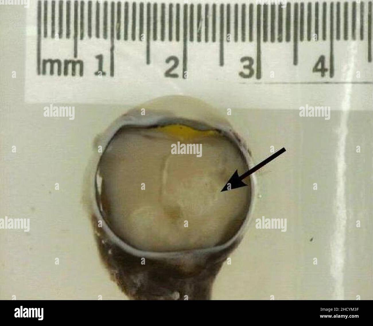 Retinoblastoma in enucleated eyeball Stock Photo - Alamy