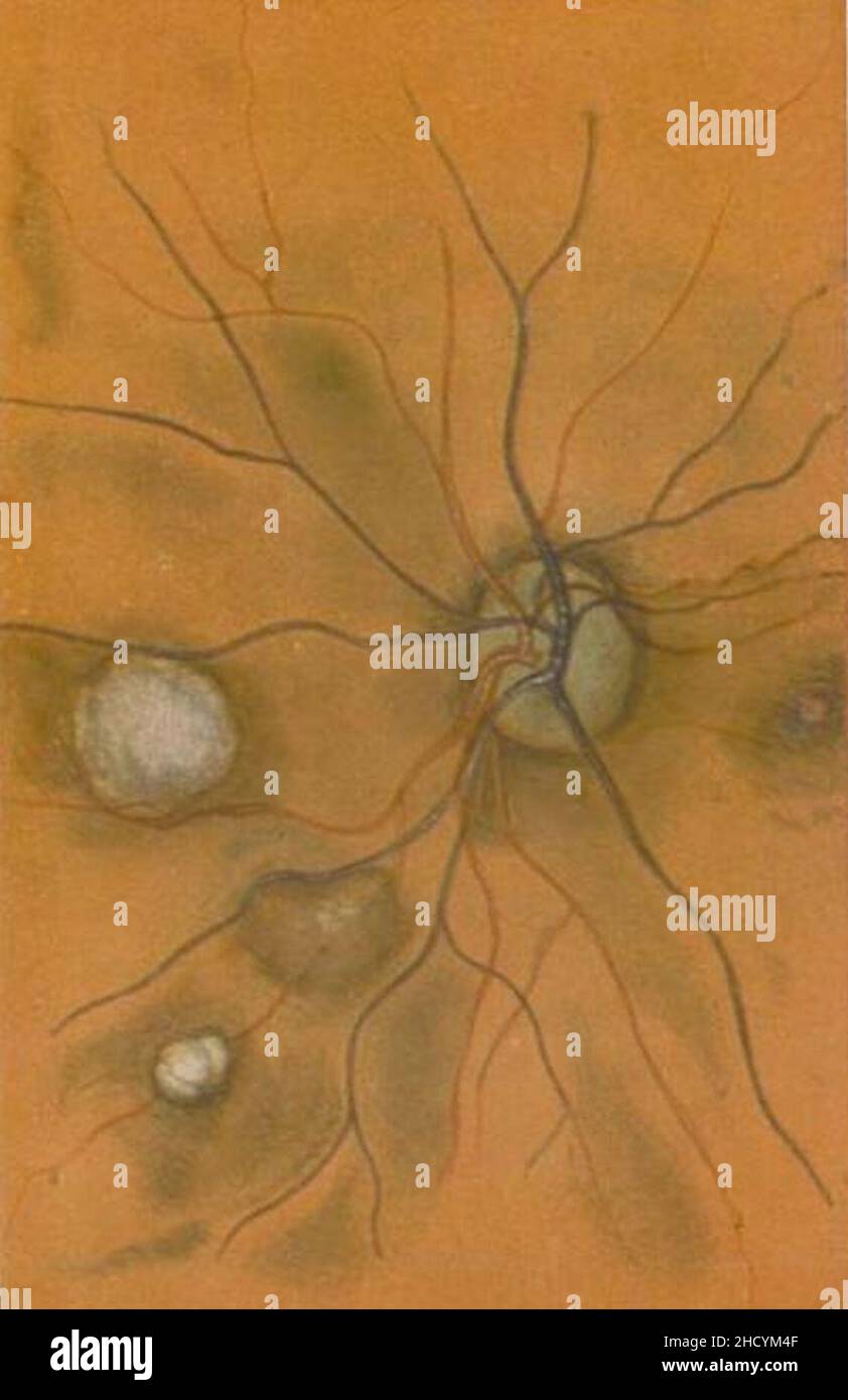 Retinal phakoma (1921 drawing by Jan van der Hoeve Stock Photo - Alamy