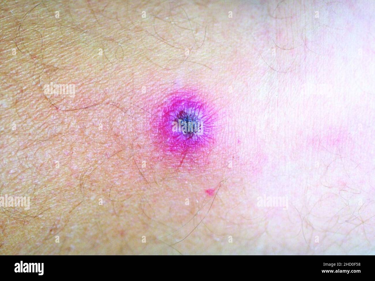 Rickettsialpox hi-res stock photography and images - Alamy