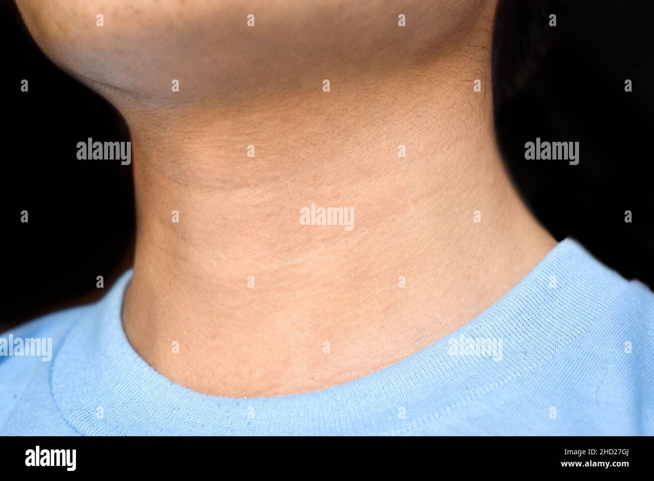 Aging skin folds or skin creases or wrinkles at neck of Southeast Asian ...