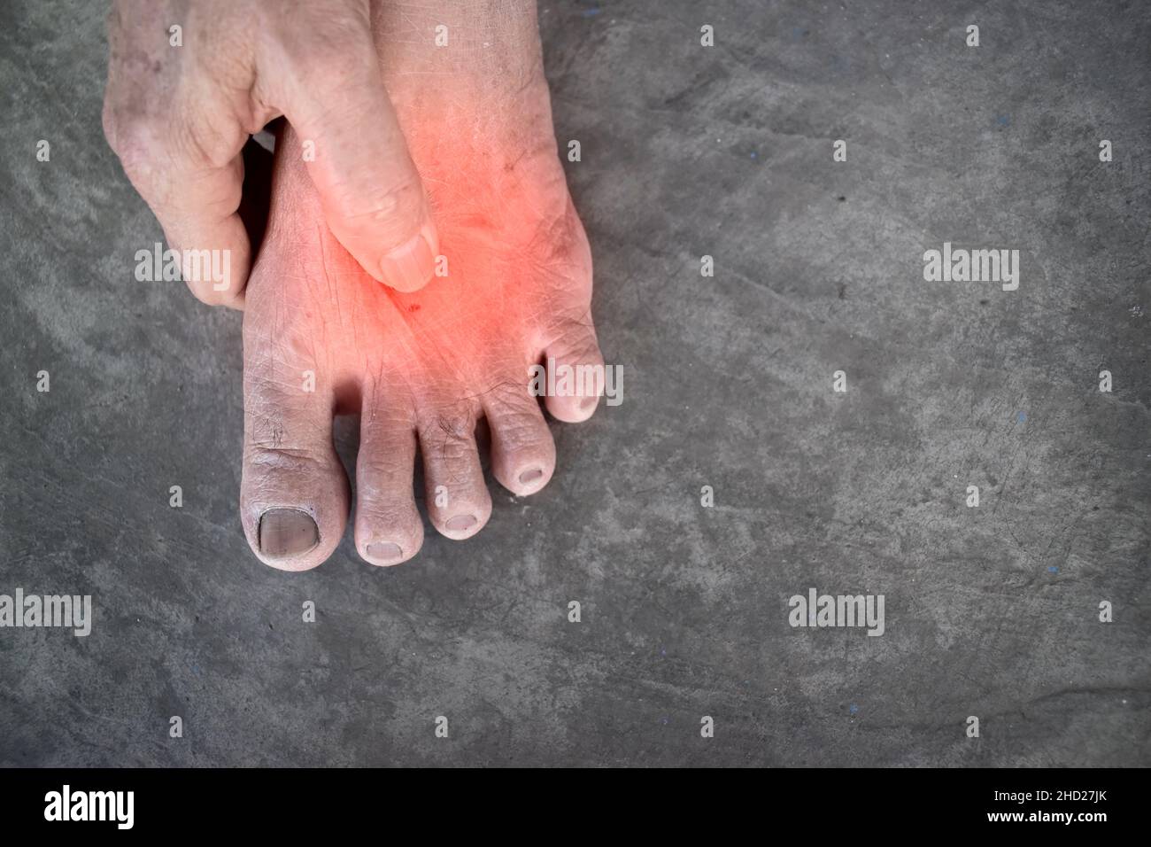 Painful foot of Asian old man with diabetes. Sensory neuropathy ...