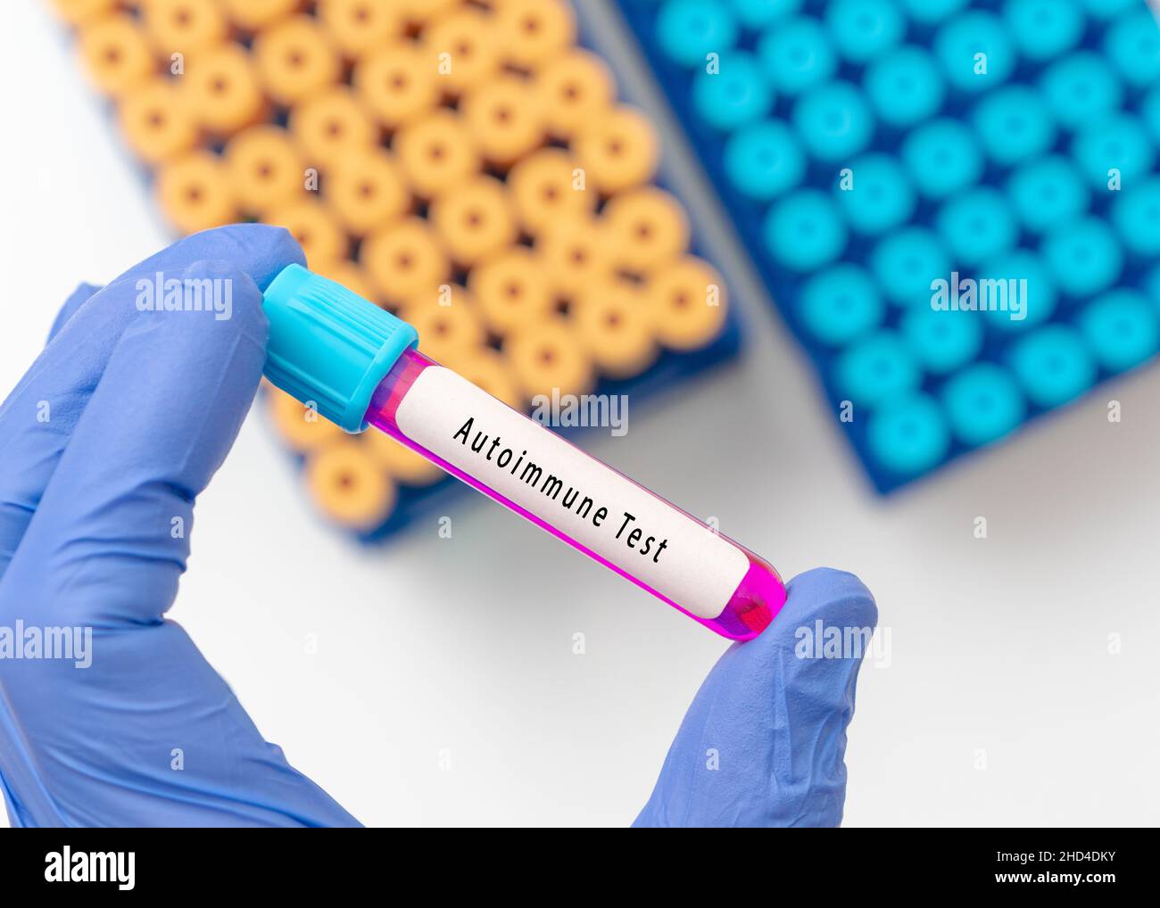 Biochemistry Blood sample for autoimmune test Stock Photo - Alamy