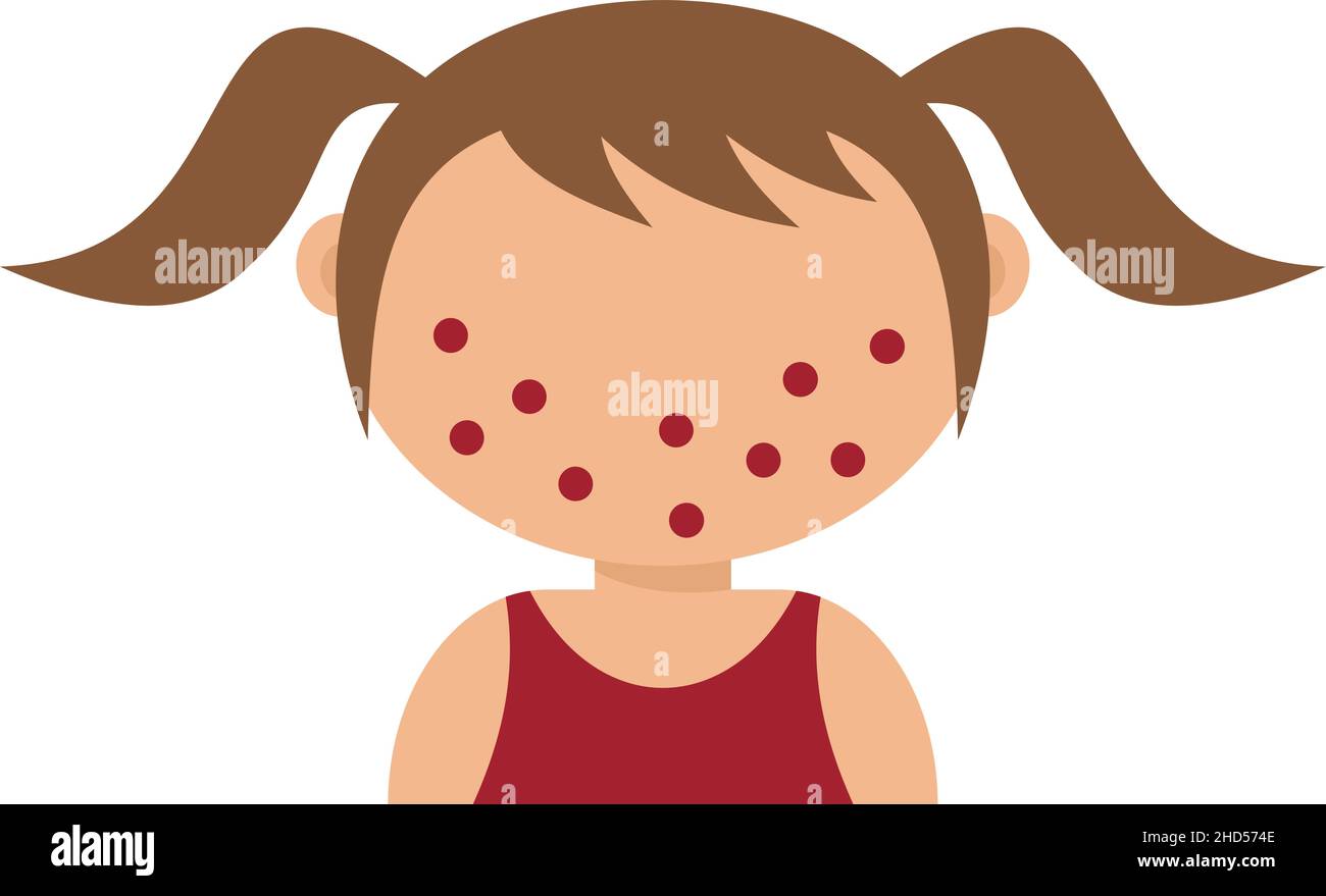 Chicken pox kid girl icon. Flat illustration of chicken pox kid girl ...