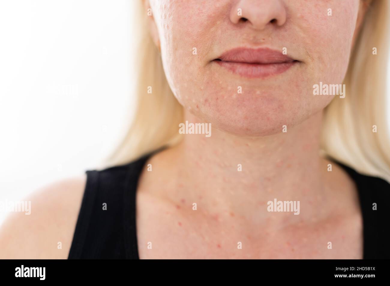 Bio-revitalization of the face and neck. The fight against the signs of ...