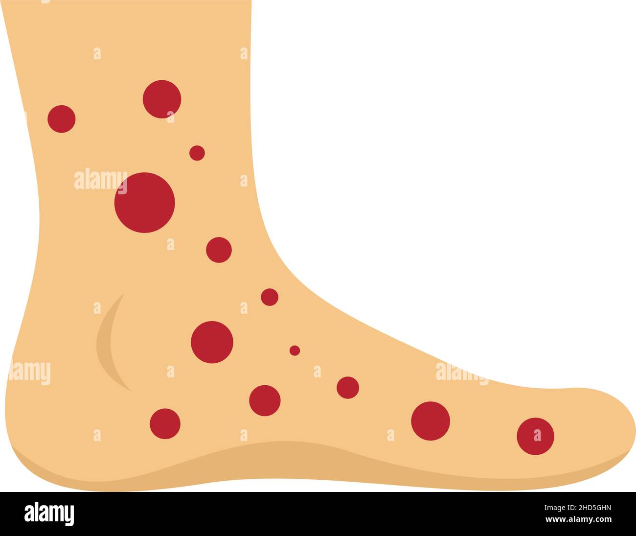 Foot measles icon. Flat illustration of foot measles vector icon ...