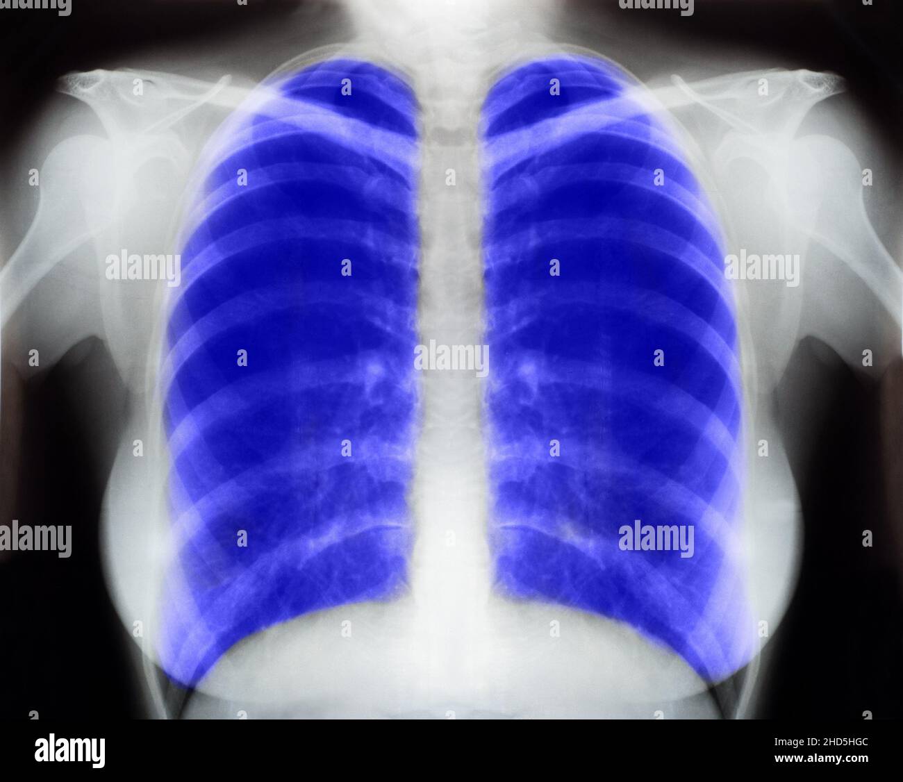 An x-ray of a human chest against a dark background Stock Photo - Alamy
