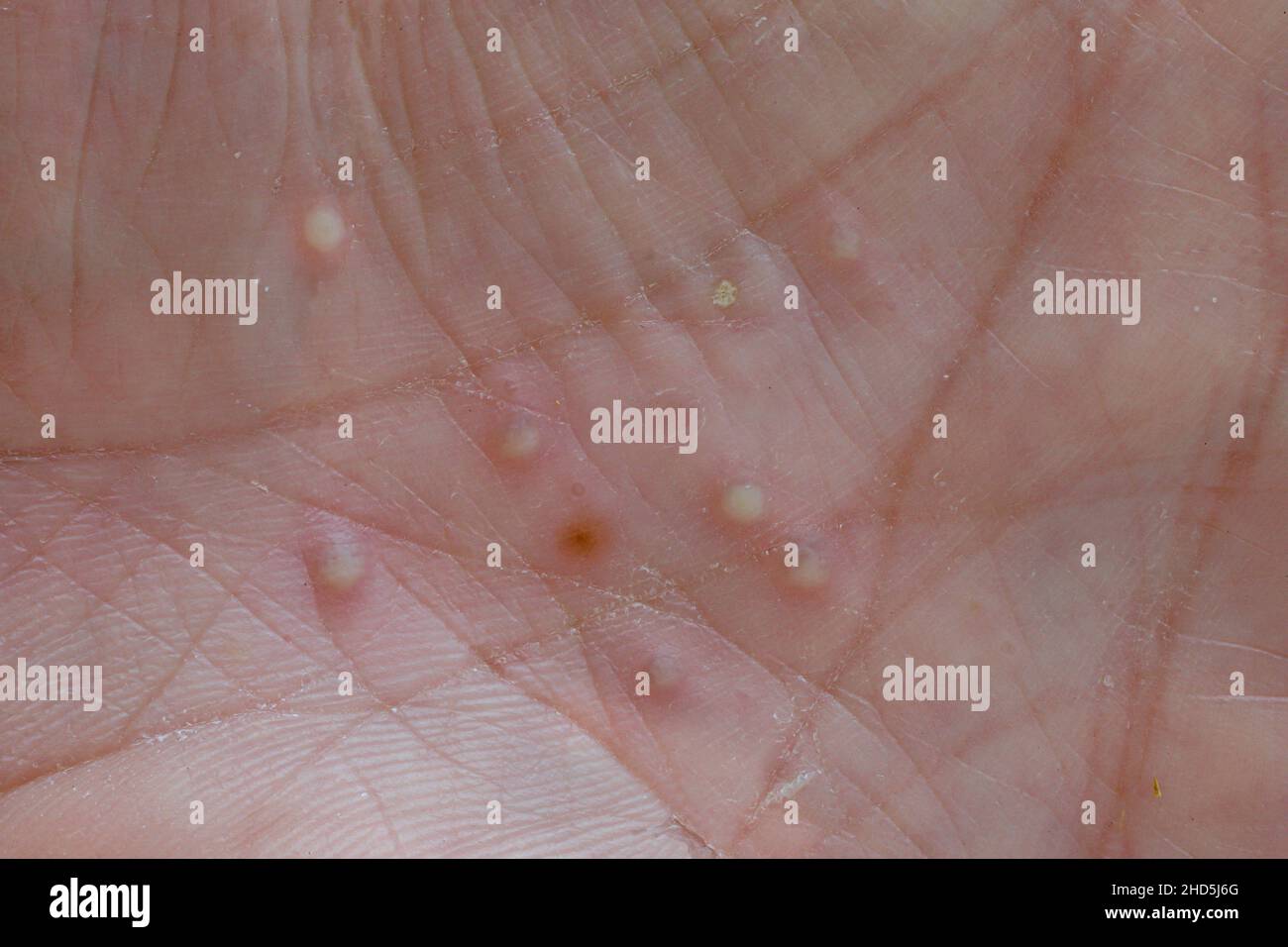 Macro photography of pustular psoriasis lesions, Palmoplantar psoriasis ...