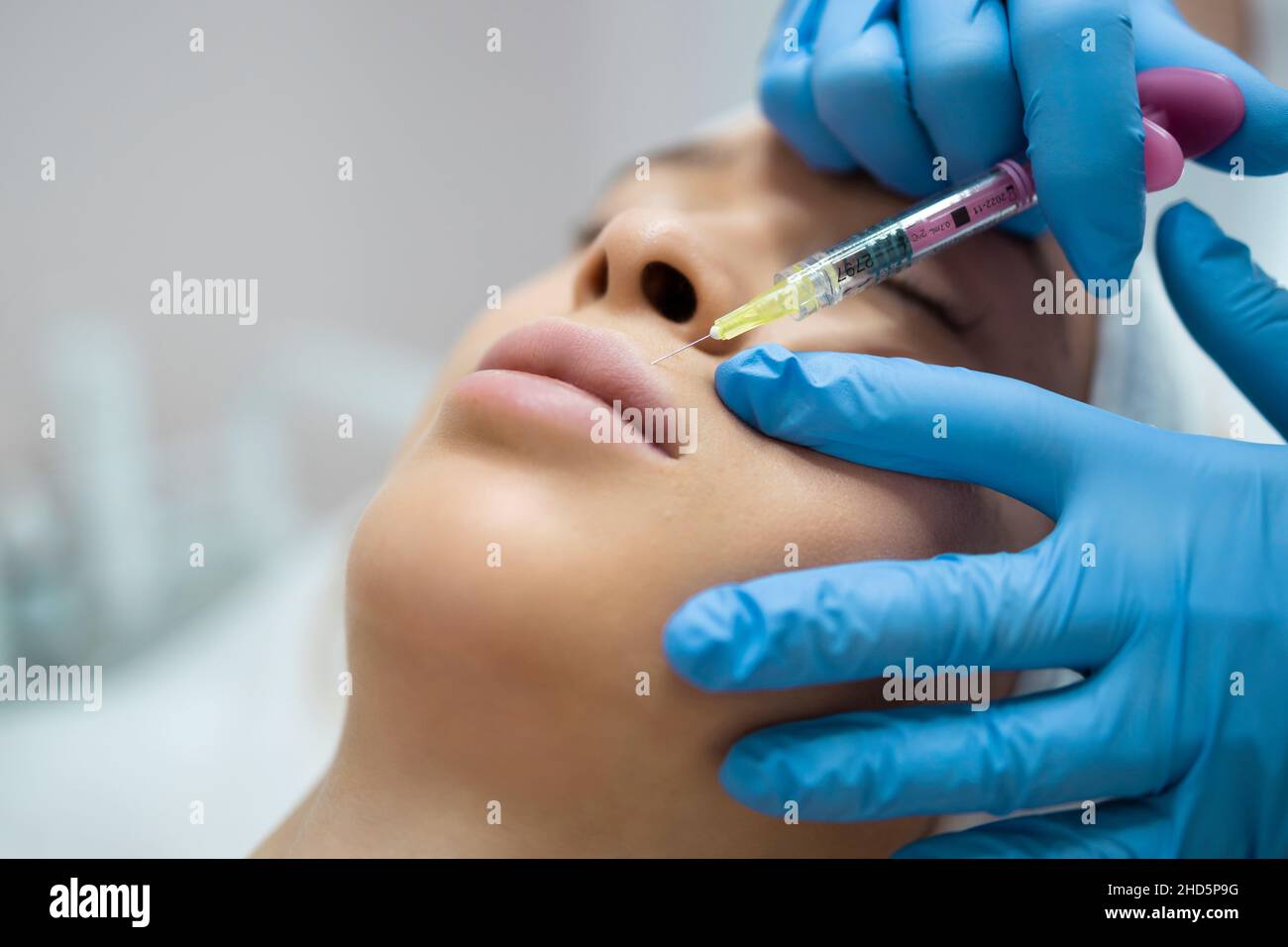 Lip augmentation and correction procedure close-up. Hyaluronic acid ...
