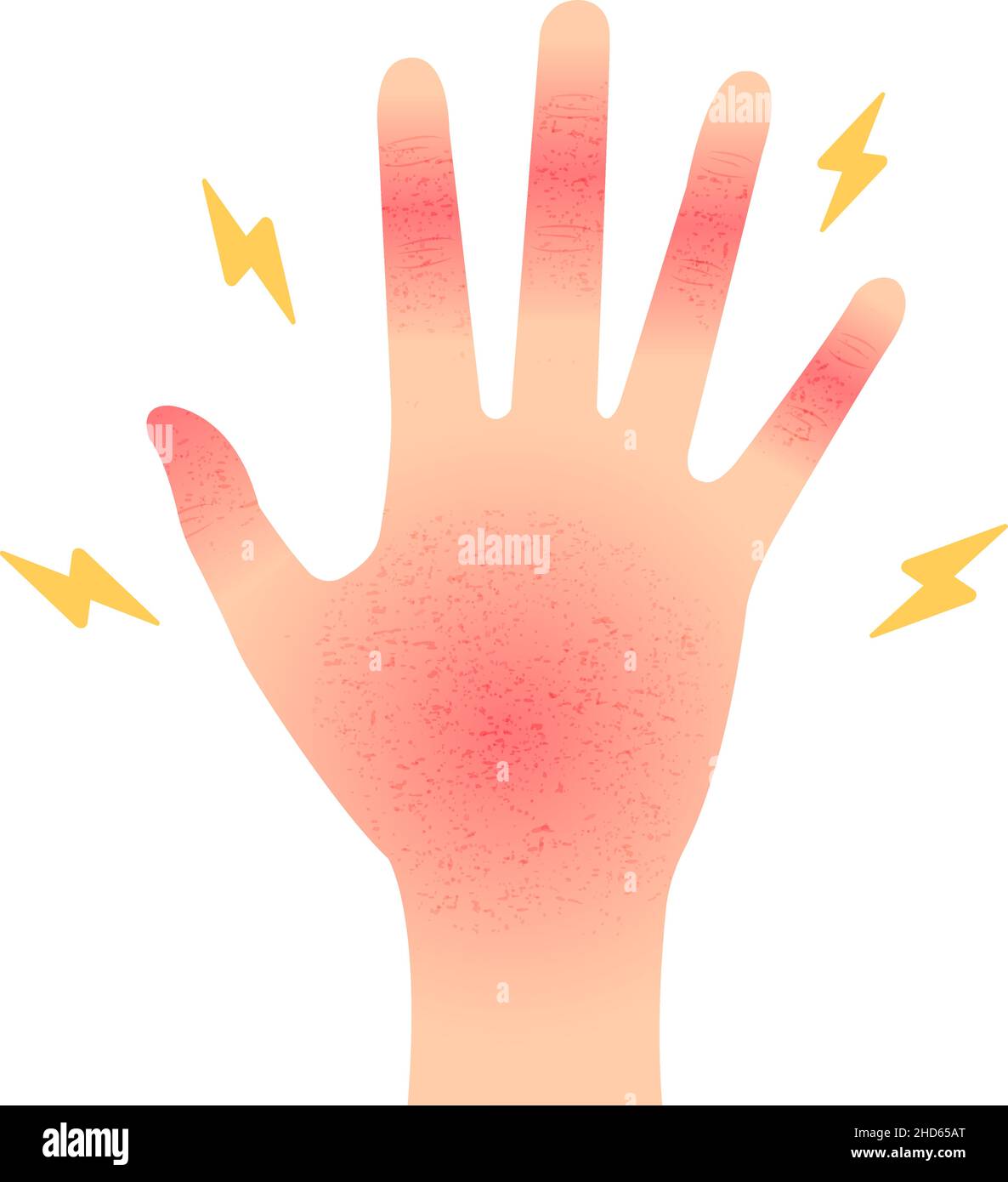 Dry And Rough Hands Chapped Hands Vector Illustration Stock Vector Image And Art Alamy