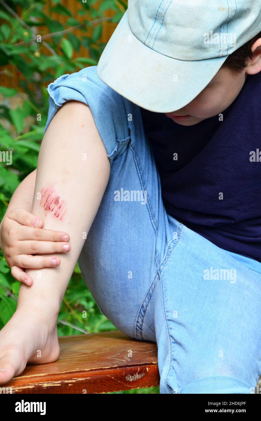 Closeup of injured young kid's knee after he fell down on pavement, the ...