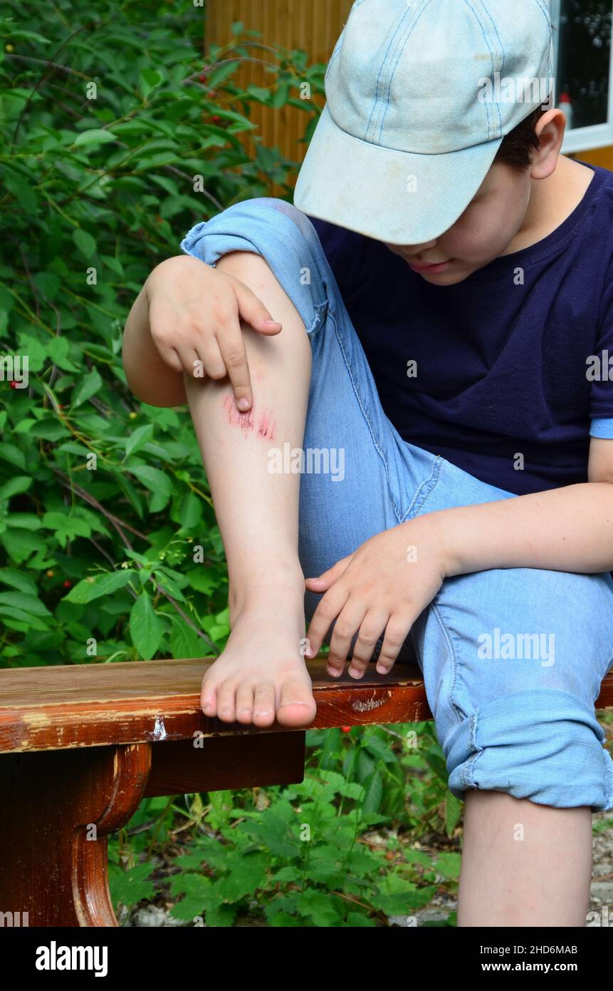 Closeup of injured young kid's knee after he fell down on pavement, the ...