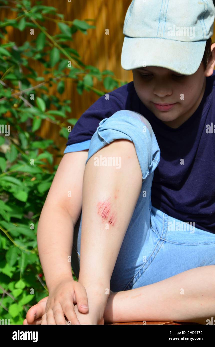 Closeup of injured young kid's knee after he fell down on pavement, the ...