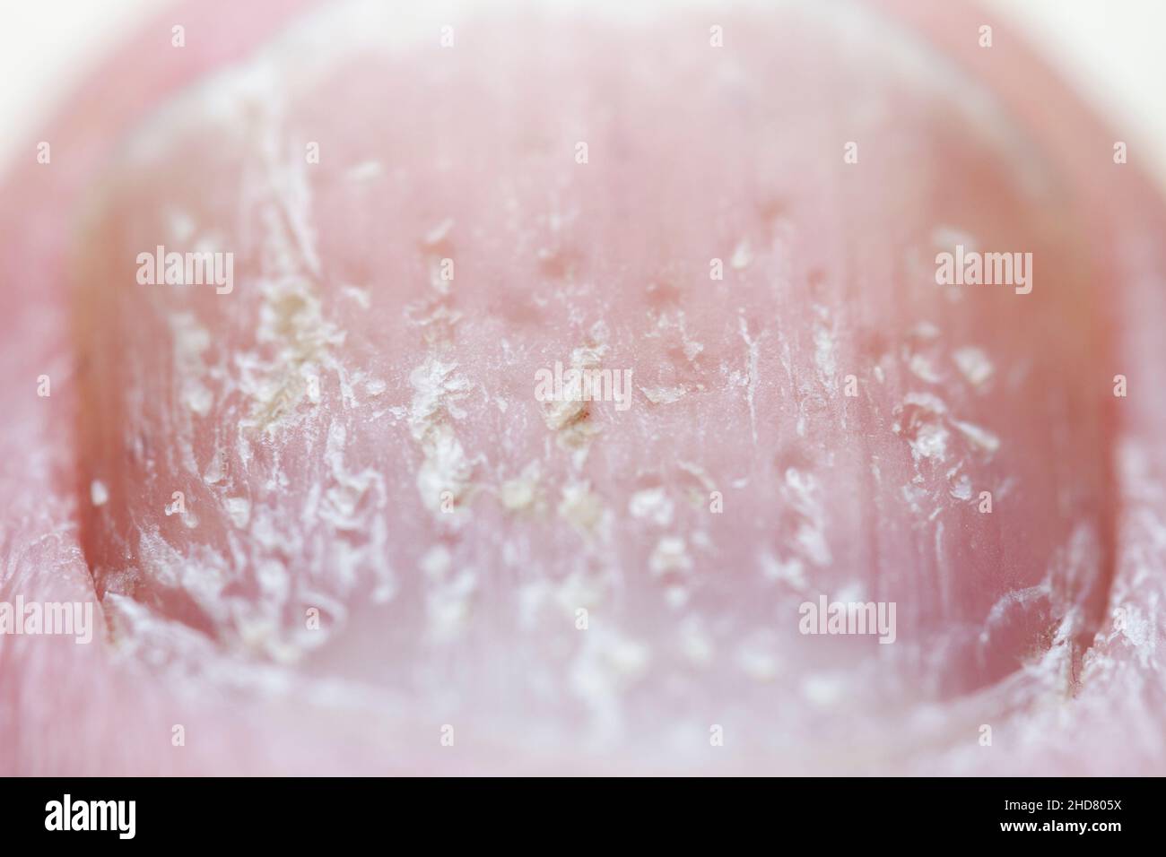 Extreme close up of psoriasis at the nail. Psoriasis is an autoimmune ...