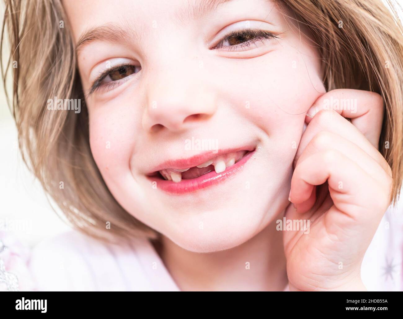 A young girl with two deciduous front incisor teeth missing and two ...