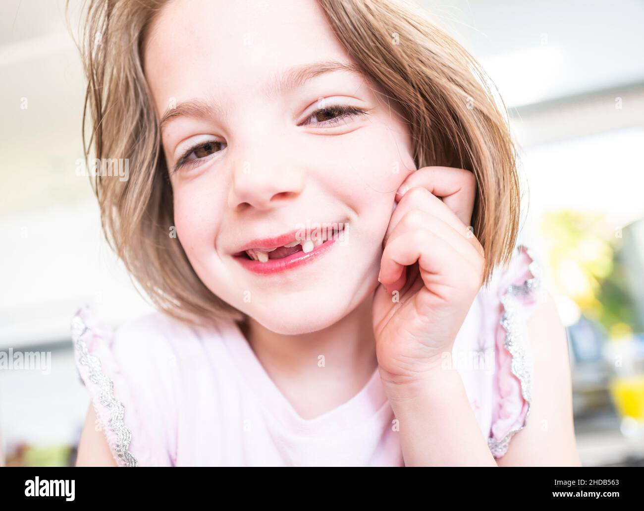 A young girl with two deciduous front incisor teeth missing and two ...