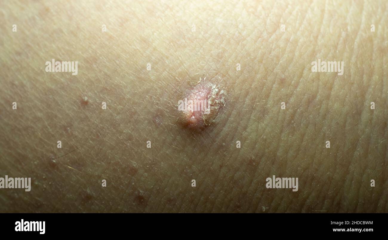 Dangerous melanoma hi-res stock photography and images - Alamy