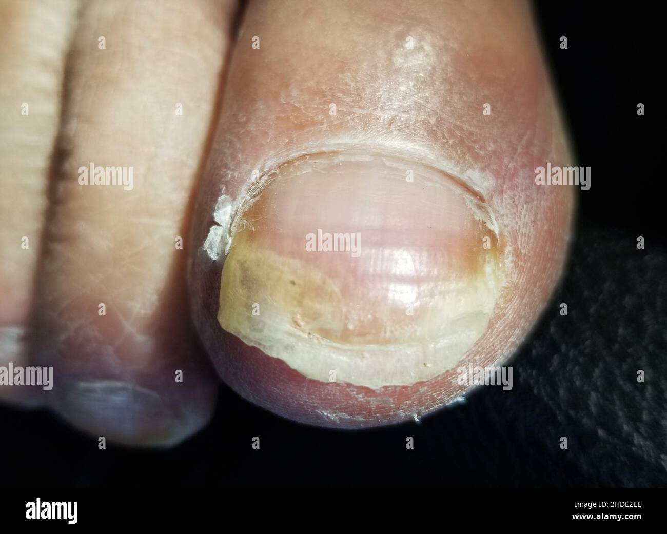 Long toe hi-res stock photography and images - Alamy