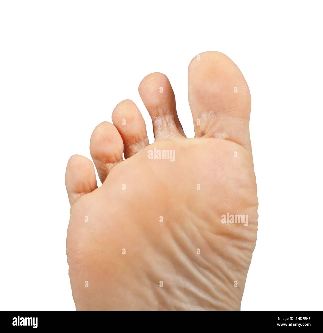sole of foot, mycosis, athletes foot , sole of foots, athletes foot s ...