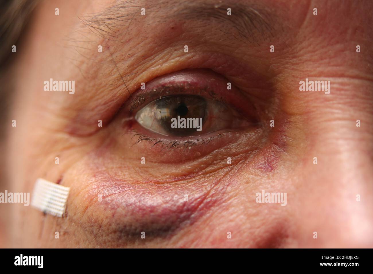 eye, bruise, eyes, bruises Stock Photo - Alamy