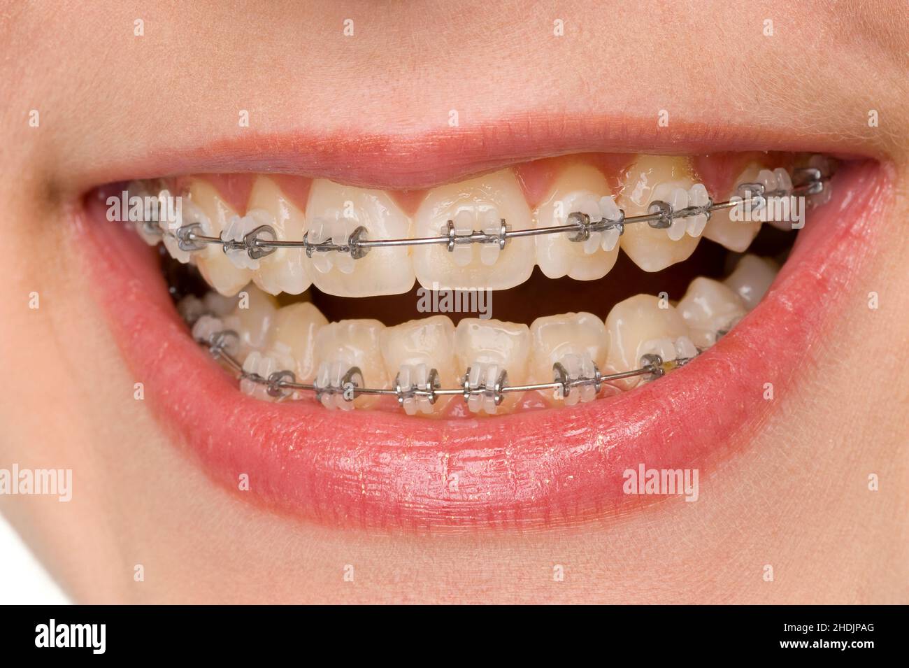 Tooth corrections hi-res stock photography and images - Alamy