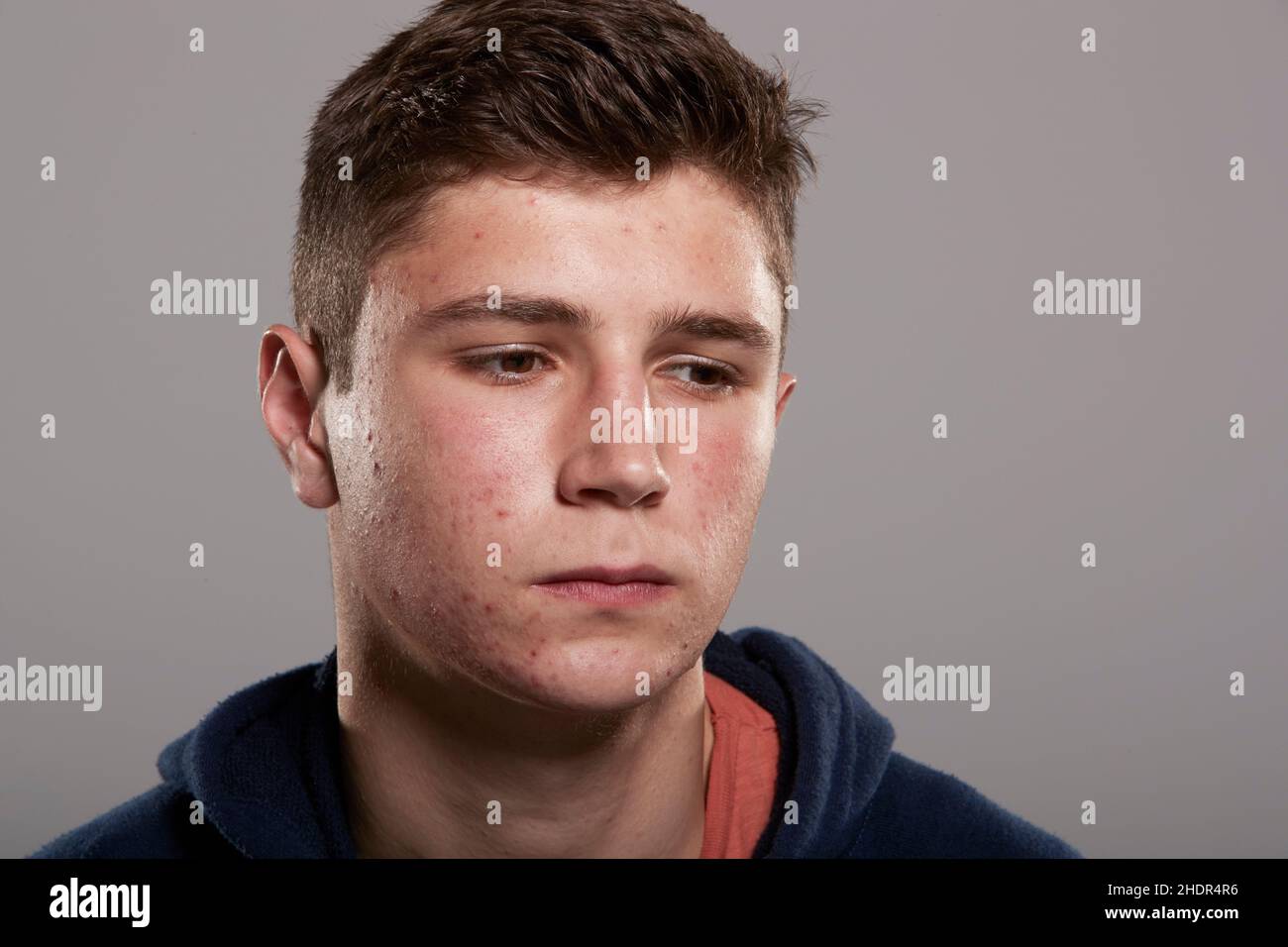 Teenagers acne hi-res stock photography and images - Alamy