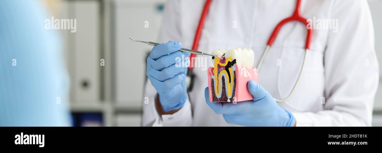 Dentist shows on dental model how caries destroys tooth enamel Stock ...