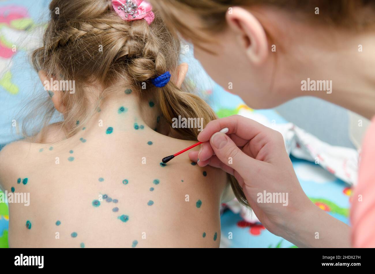 Two pox hi-res stock photography and images - Alamy