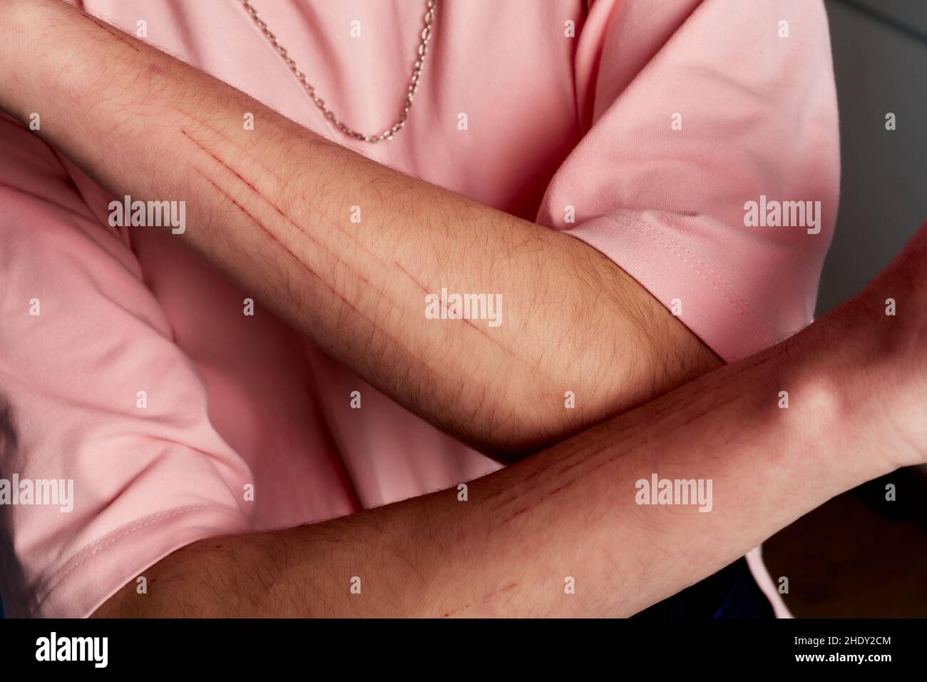Cat scratch disease hi-res stock photography and images - Alamy