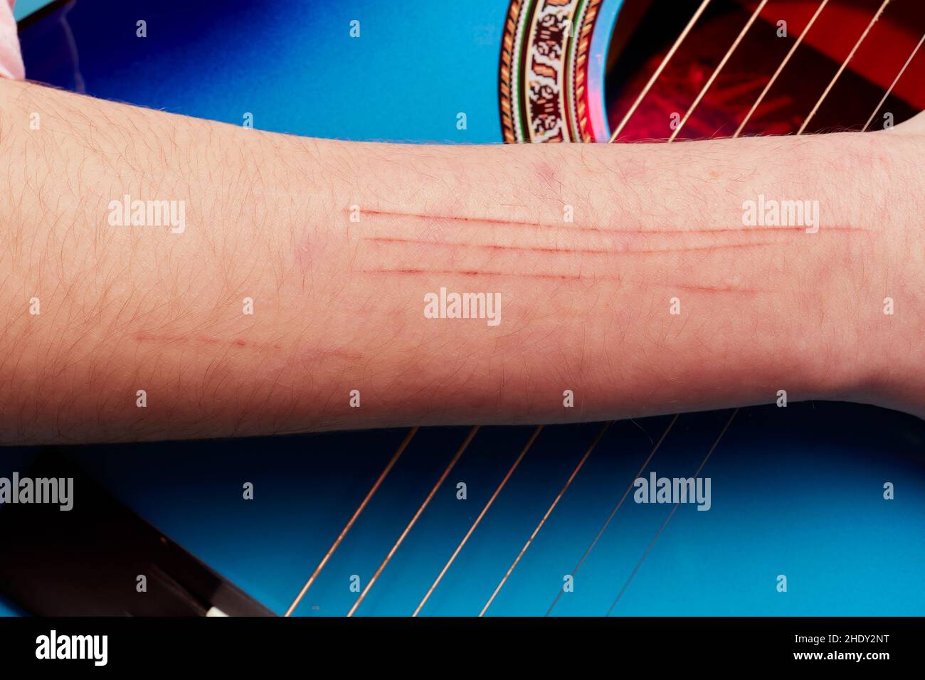 The skin condition after cat scratch and bite of veterinary surgeon ...