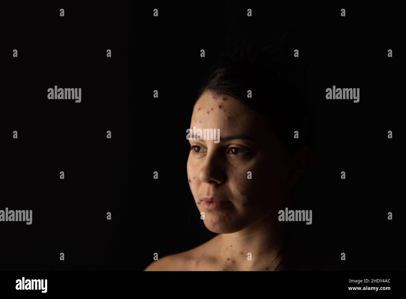 adult woman portrait chickenpox disease key light Stock Photo - Alamy