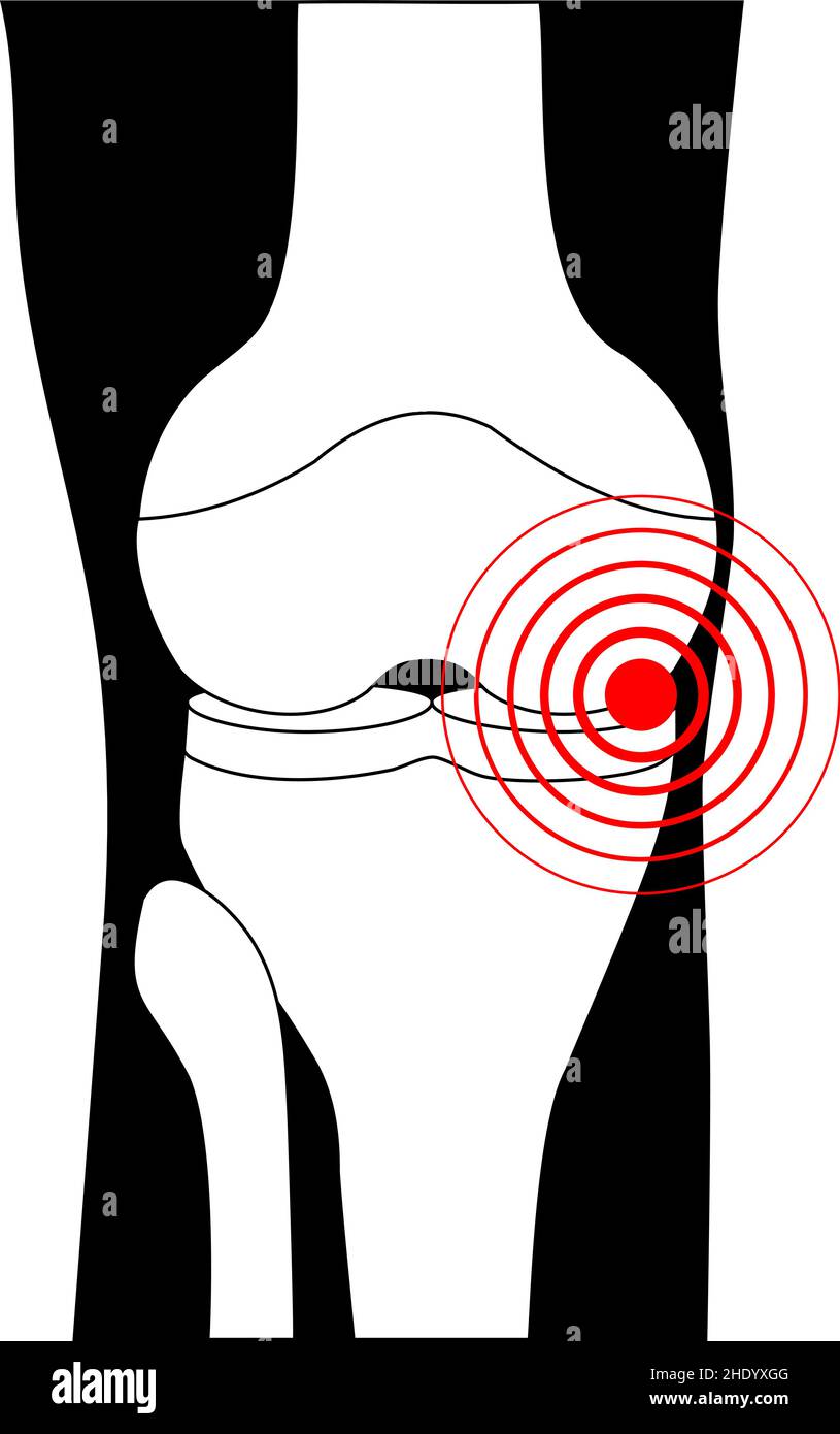 Joint pain icon. knee osteoarthritis. Black and white symbol. Bones of a human's leg. injury ...