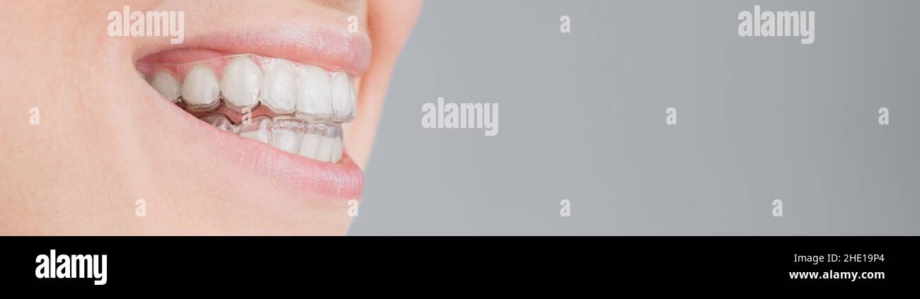 Close-up portrait of a woman putting on a transparent plastic retainer ...