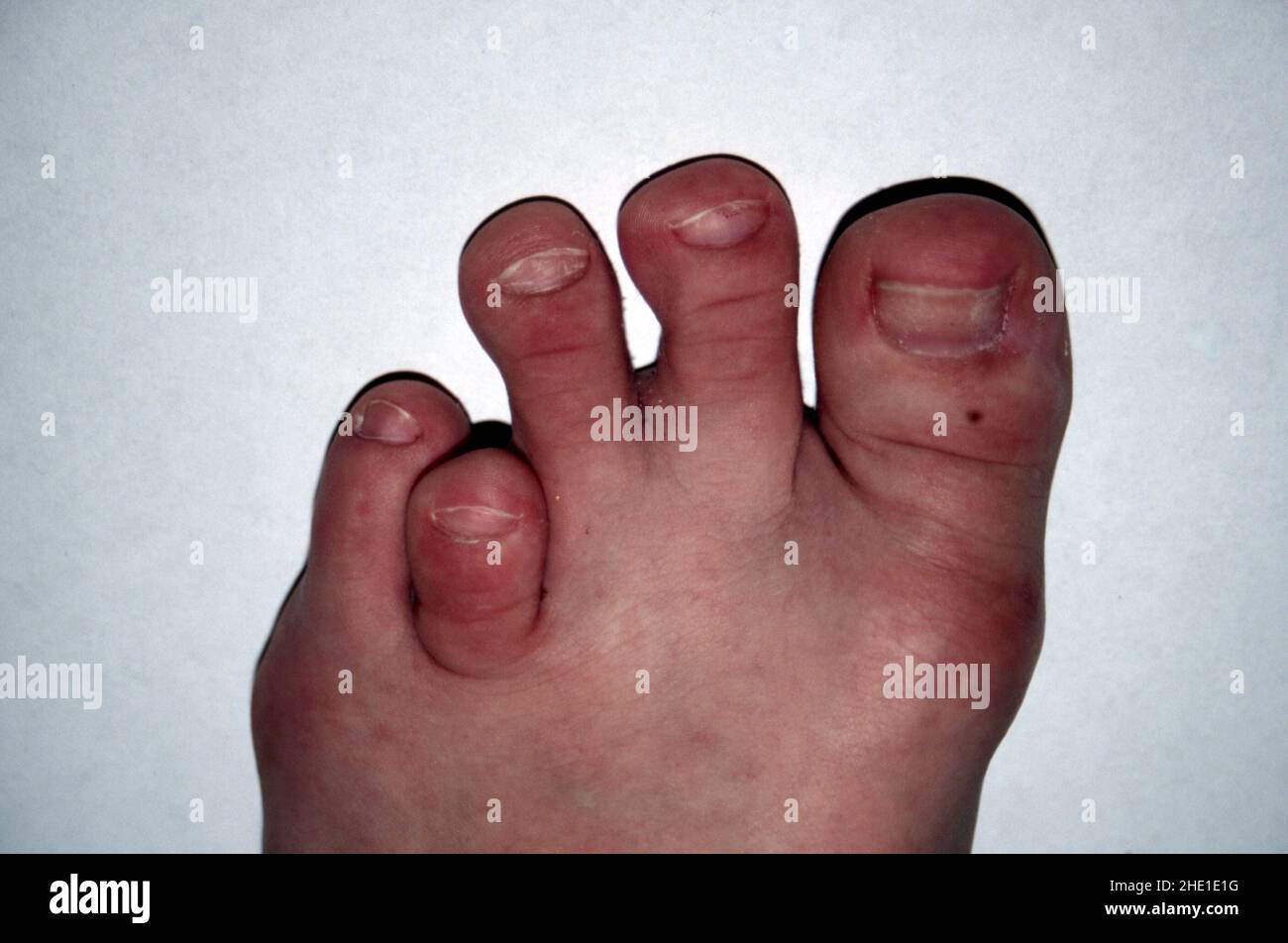 Bone fractures hi-res stock photography and images - Alamy