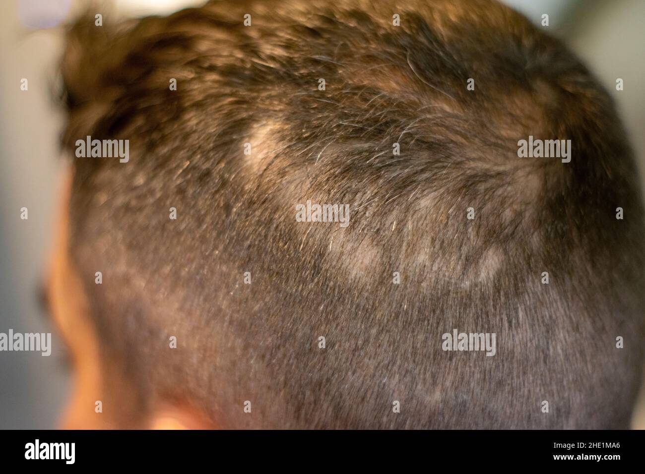 Air loss issues, hair treatment and dermatologic diseases on the scalp ...