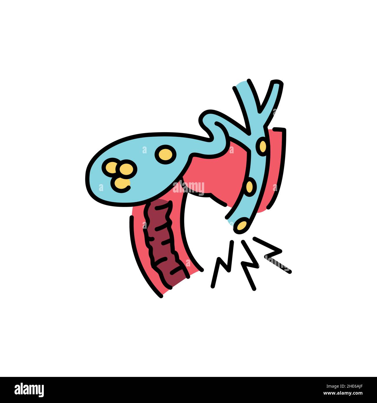Chronic cholecystitis color line icon. Human diseases Stock Vector ...