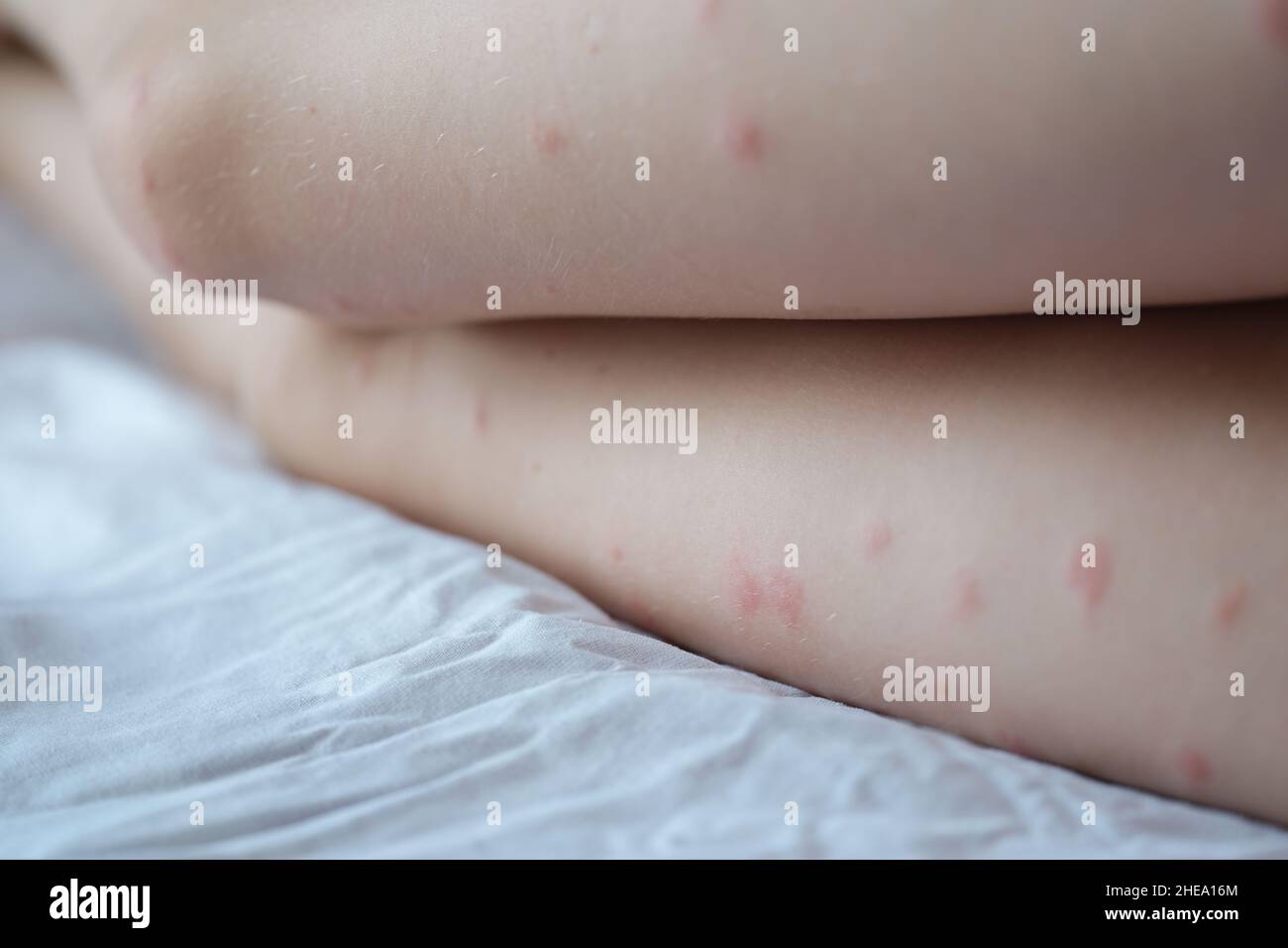 Red rash on the white skin of female legs, pimples Stock Photo - Alamy