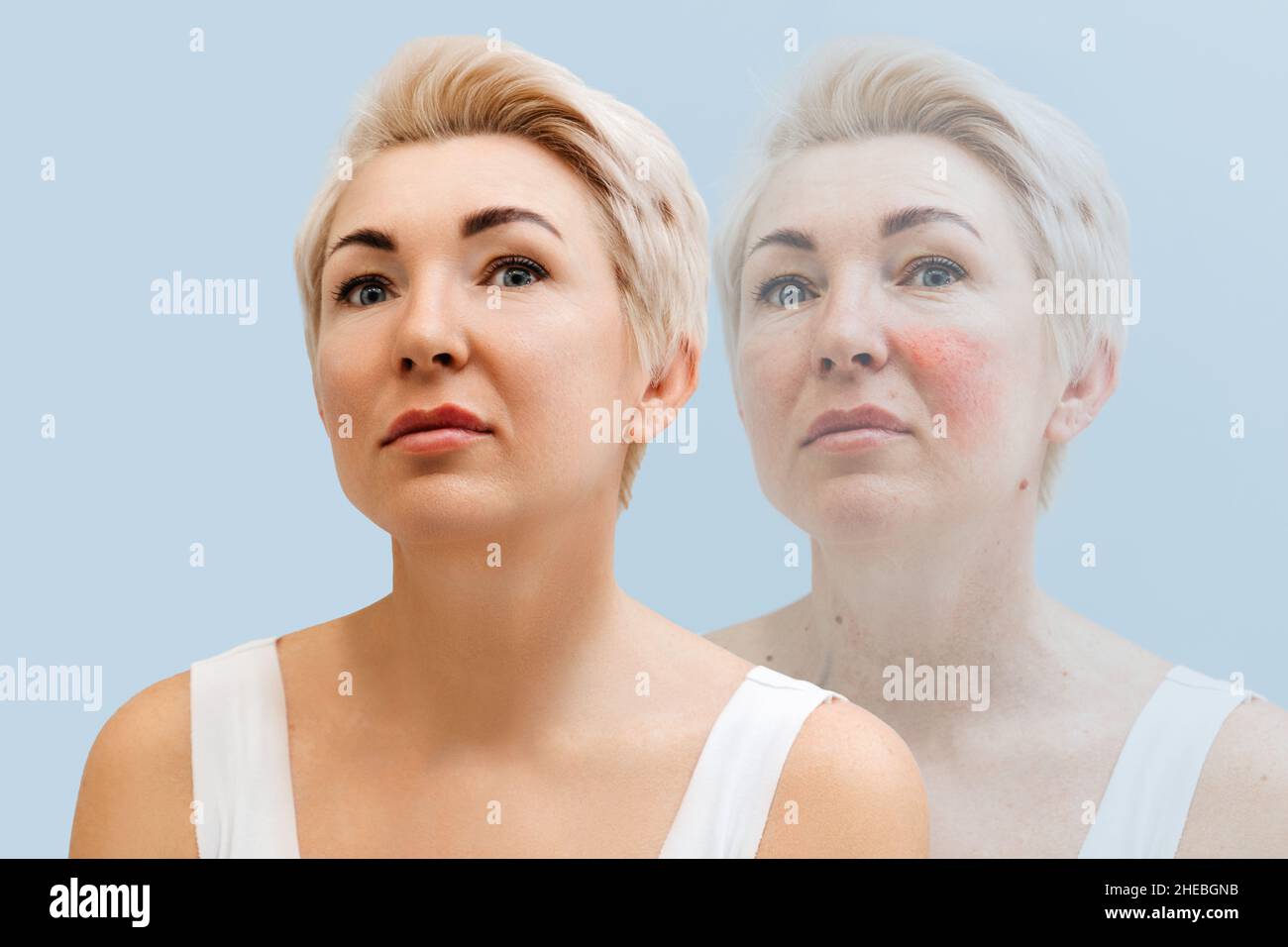 Rosacea before after hi-res stock photography and images - Alamy
