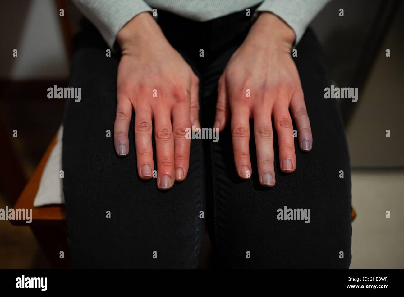 Hands of person with Raynaud's phenomenon during attack with some ...