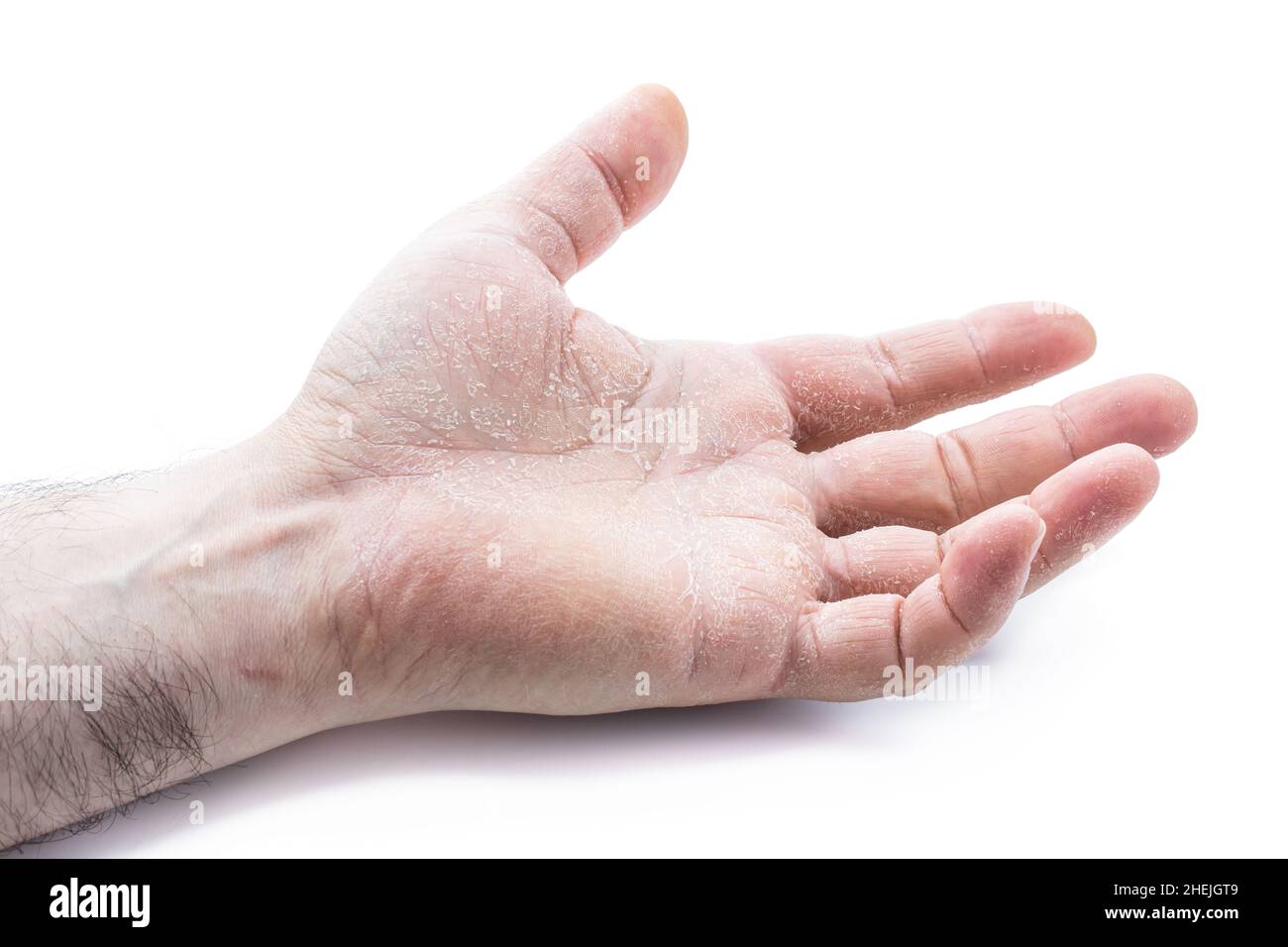 image of the mens hand showing skin disease isolated on white ...