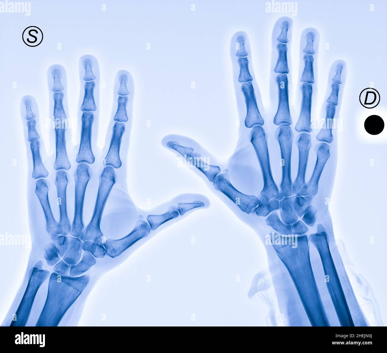 X ray hands arthritis hi-res stock photography and images - Alamy