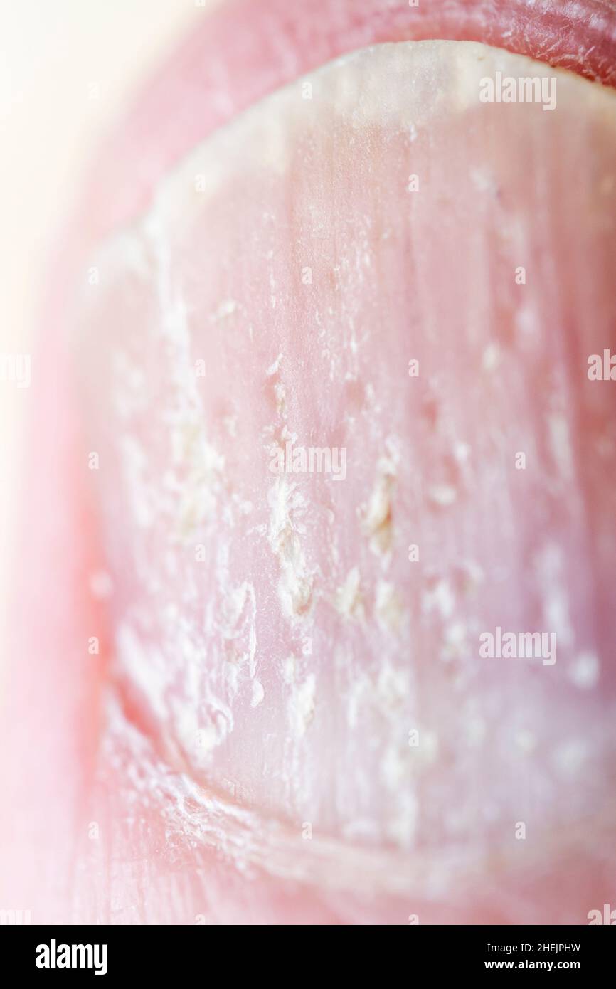 Extreme close up of psoriasis at the nail. Psoriasis is an autoimmune ...