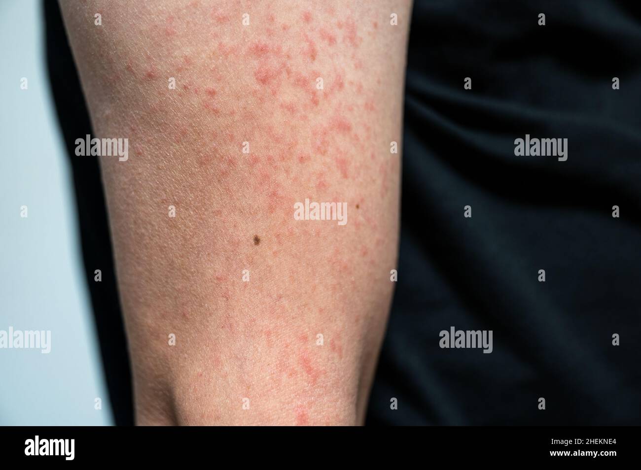 Dermatitis Rash Viral Disease With Immunodeficiency On Arm Of Young Adult Asian Scratch With