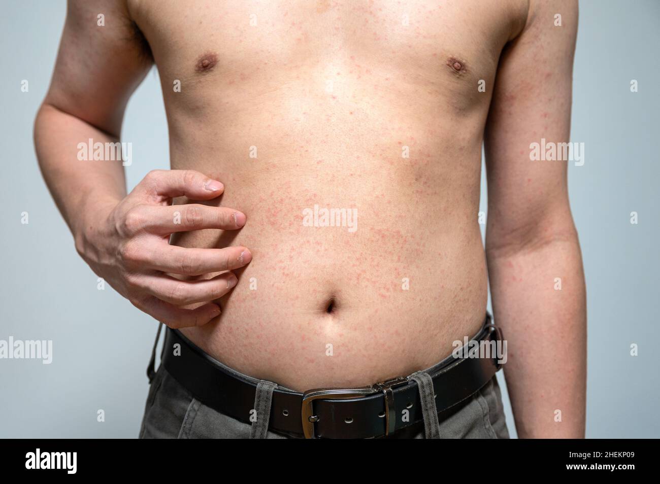 Dermatitis rash viral disease with immunodeficiency on body of young ...